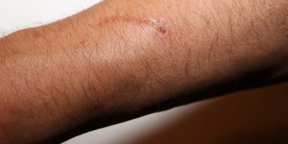 Bahaya HCl serta Cara Mengantisipasi dan Menangani Dampaknya - Suara ...