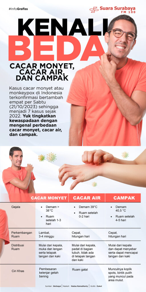 Kenali Beda Cacar Moneyet, Cacar Air, dan Campak
